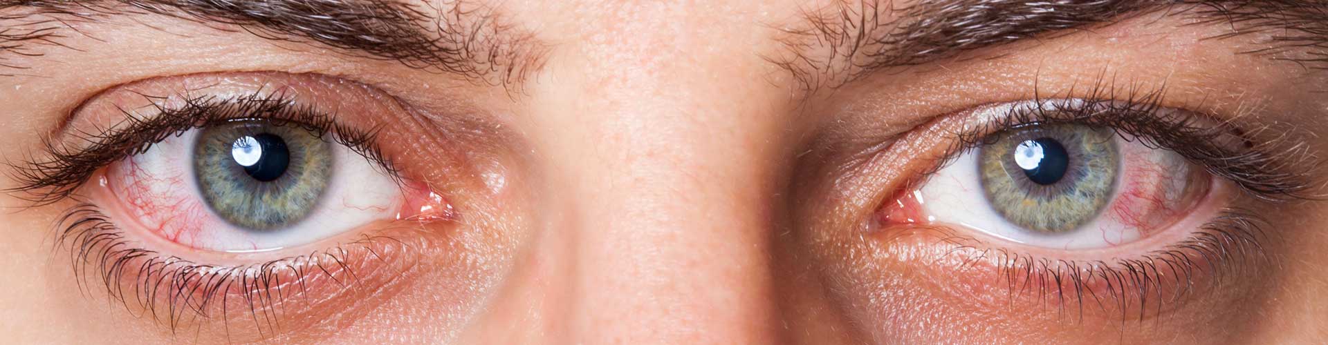 All You Need to Know about Conjunctivitis | Stamper Optometry